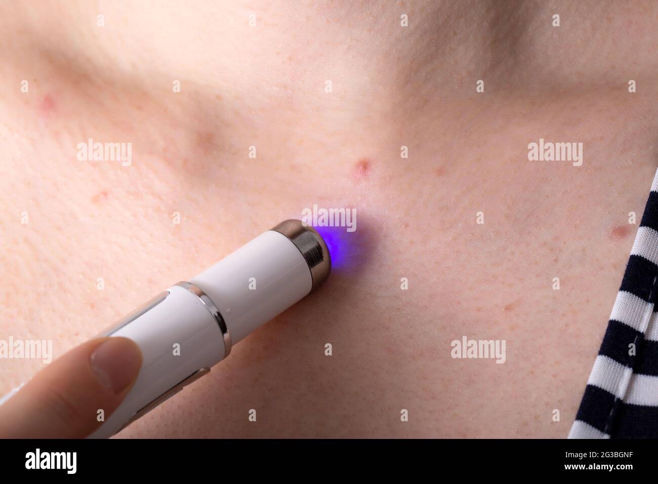 Removing a red pimple on a girl's neck with a cosmetic laser pen, macro ...