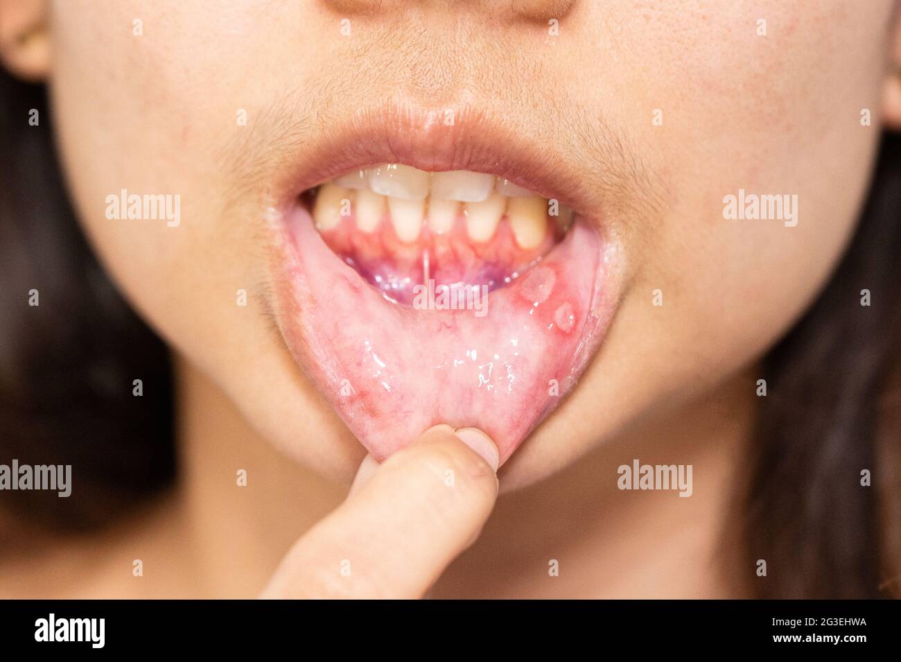 Close Up Asian Woman Have Aphthous Ulcer Or Canker Sore On Mouth At Lip