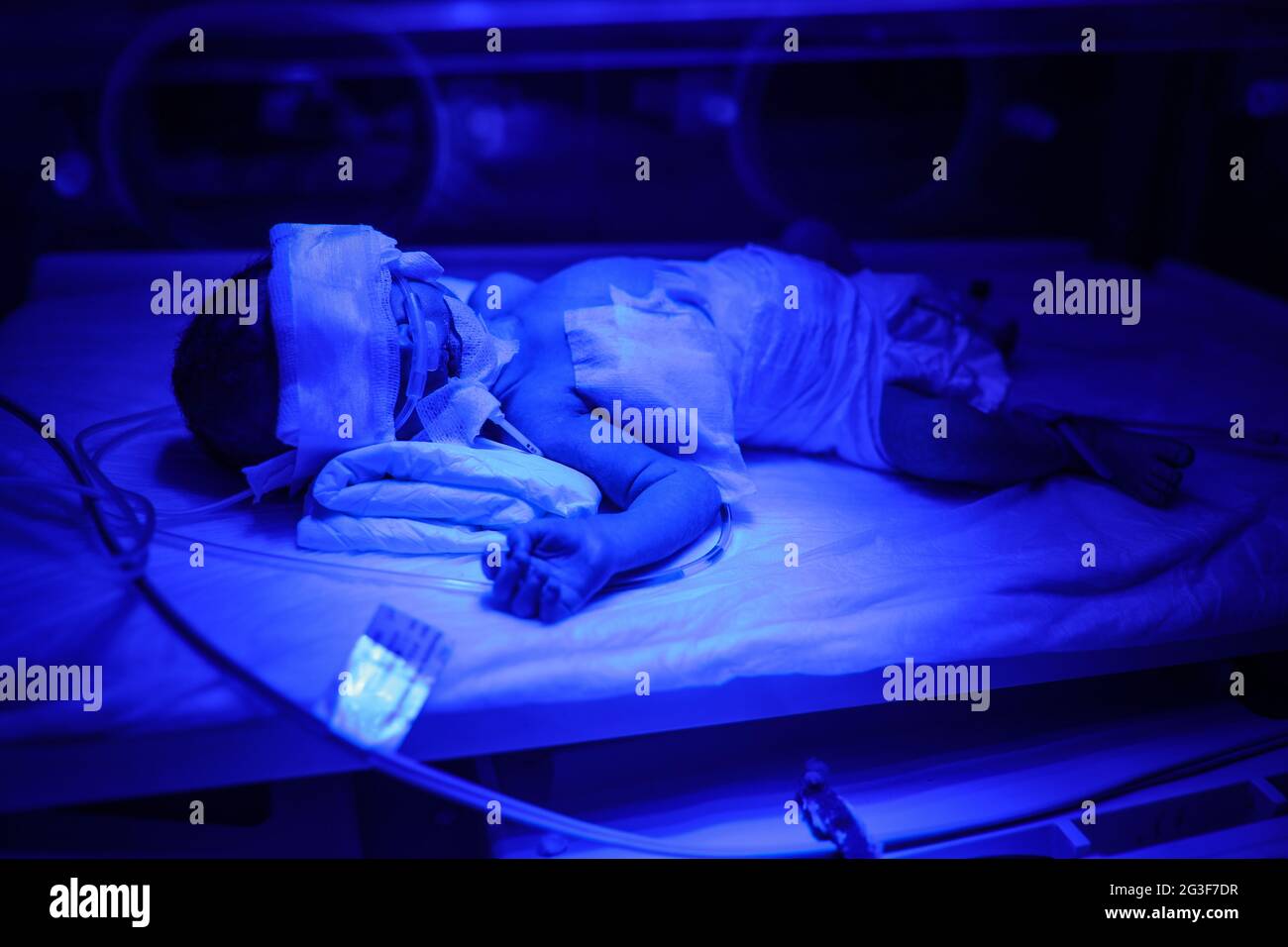 Neonatal jaundice hi-res stock photography and images - Alamy