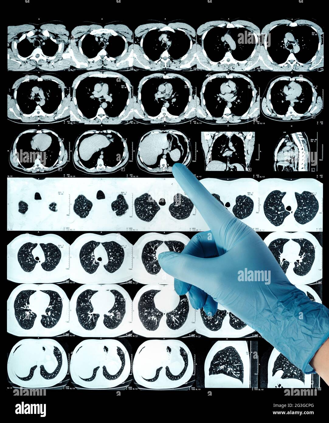 High resolution computed tomography images of a thorax in axial ...