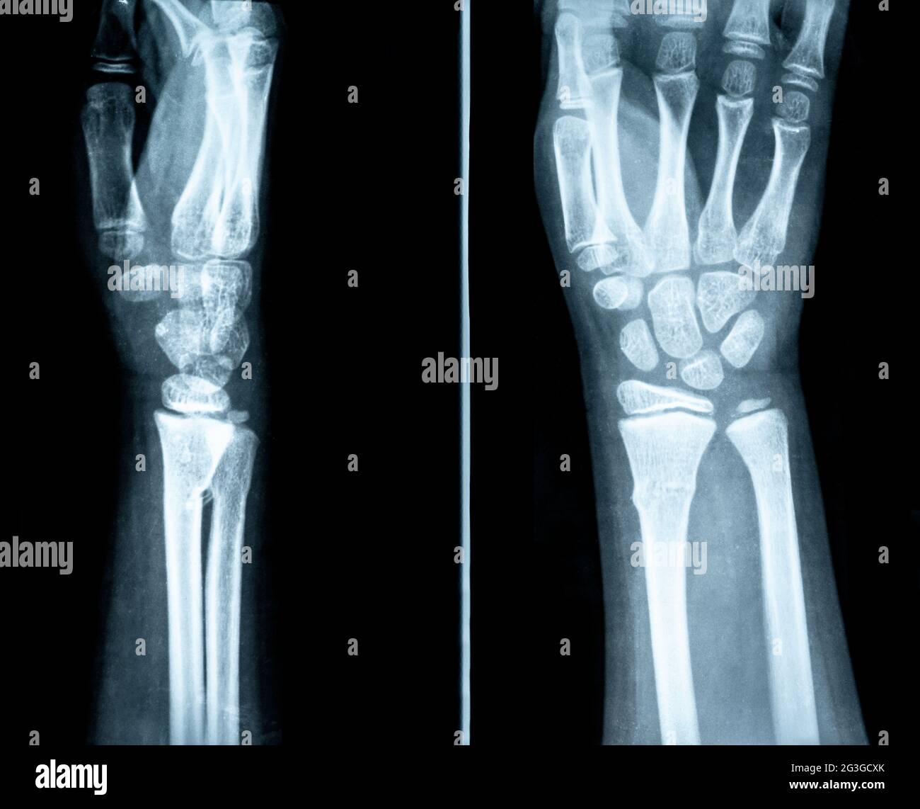 Left Hand X Ray