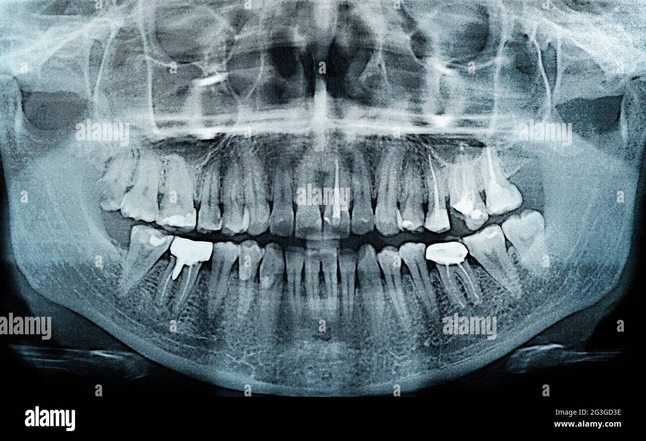 Radiography imaging upper and lower jaws teeth laboratory film Stock ...