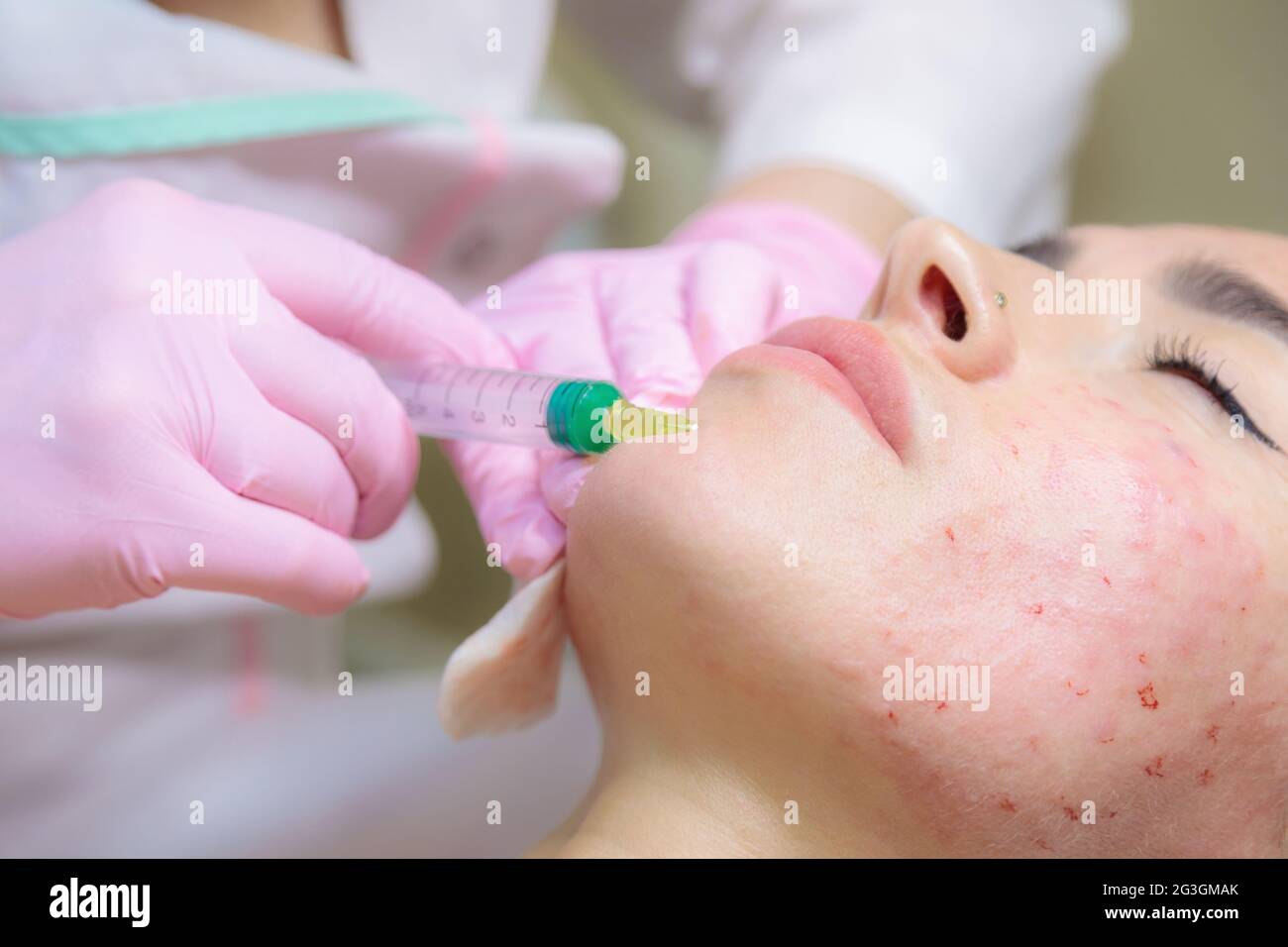 The doctor gives injections of blood plasma into the face of a young ...