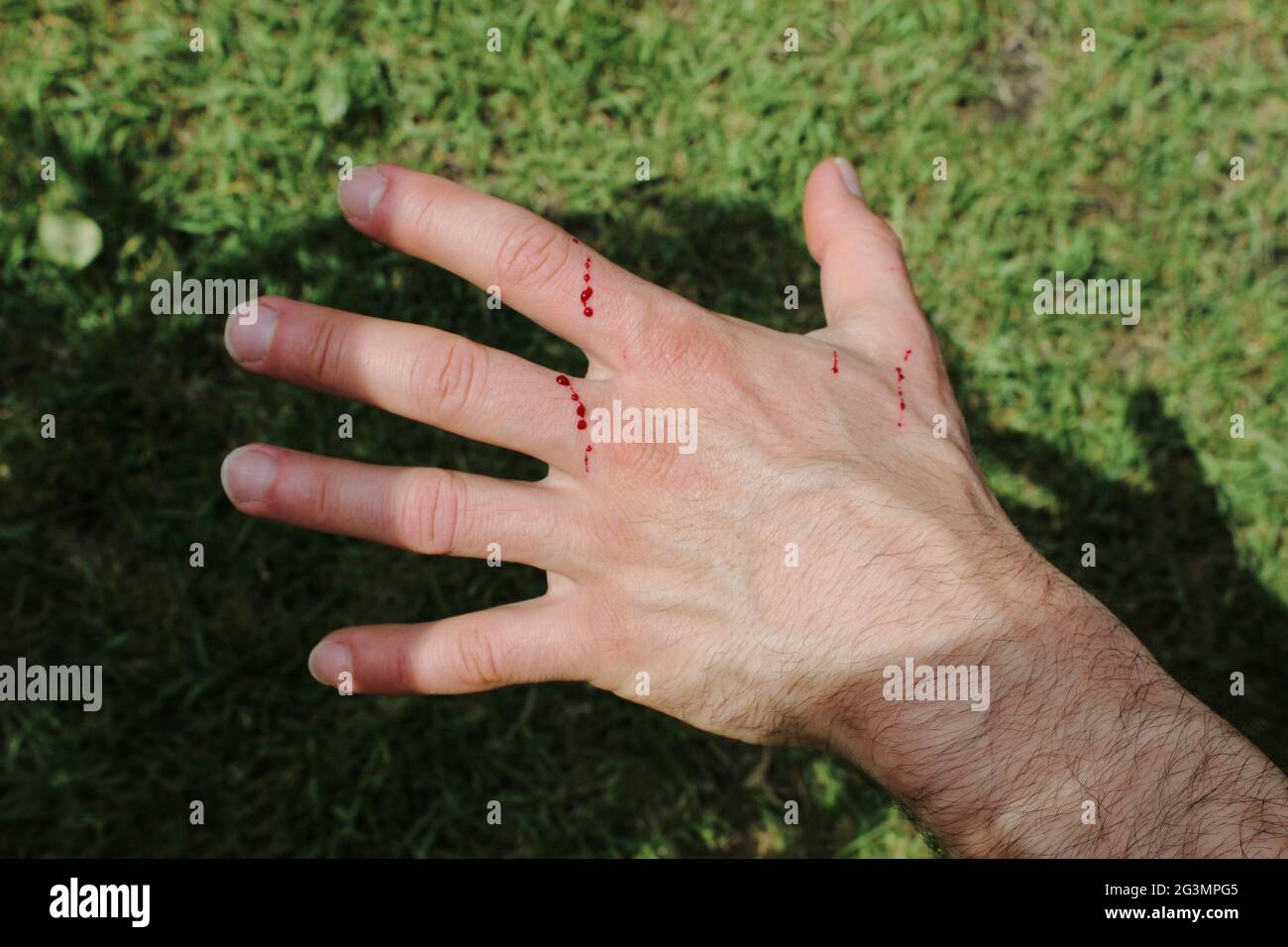 Lesion in hand hi-res stock photography and images - Alamy