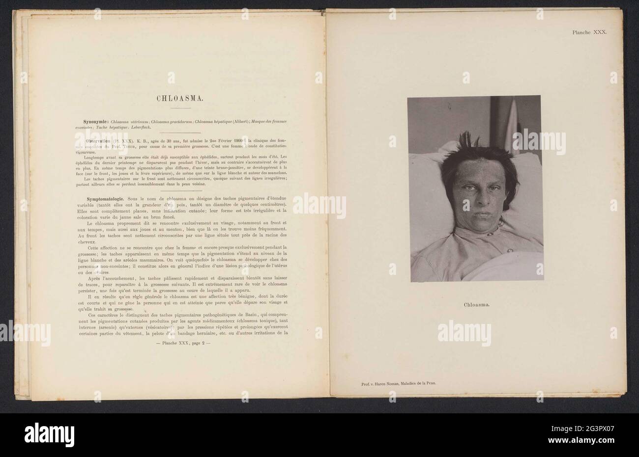 Patient suffering from the skin disease 'Chloasma'; Chloasma Stock ...