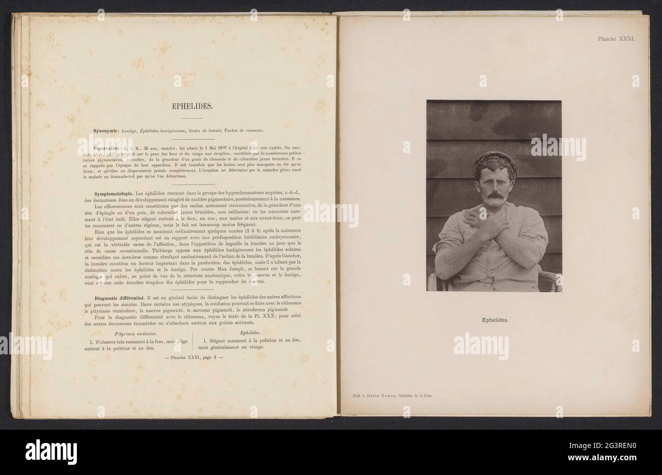 Patient suffering from the "Ephelides" skin disease; Ephelides Stock ...