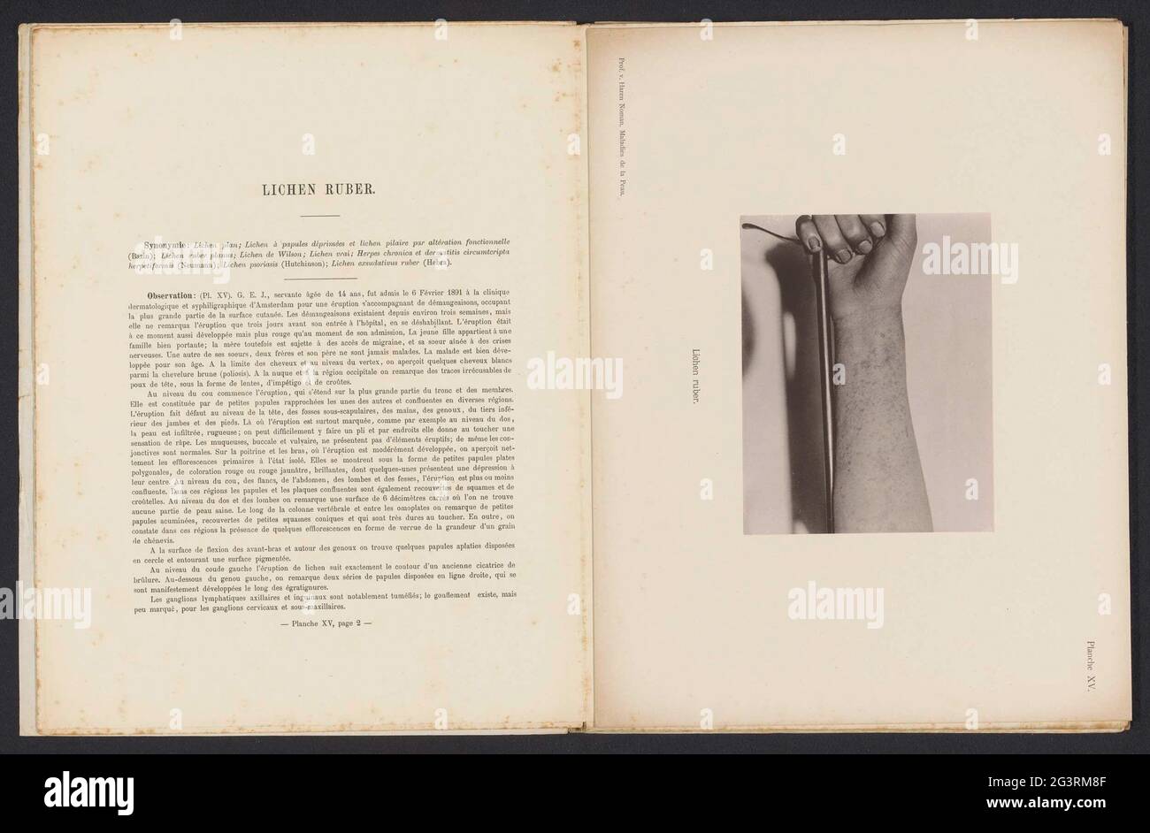 Patient suffering from the skin disease 'Lichen Ruber'; Lichen Ruber ...