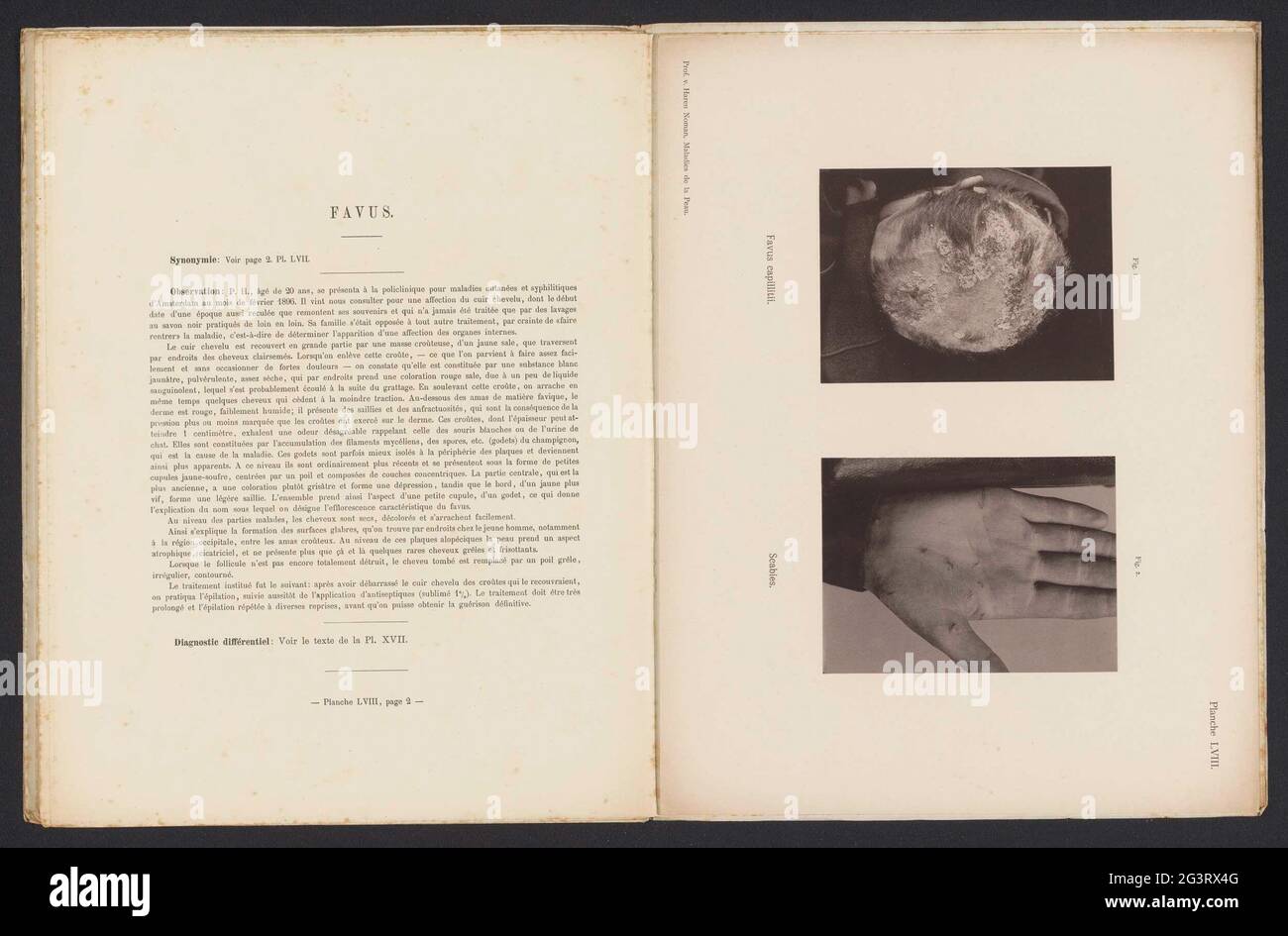 Patients suffering from the skin disease 'favus capillitii' and ...