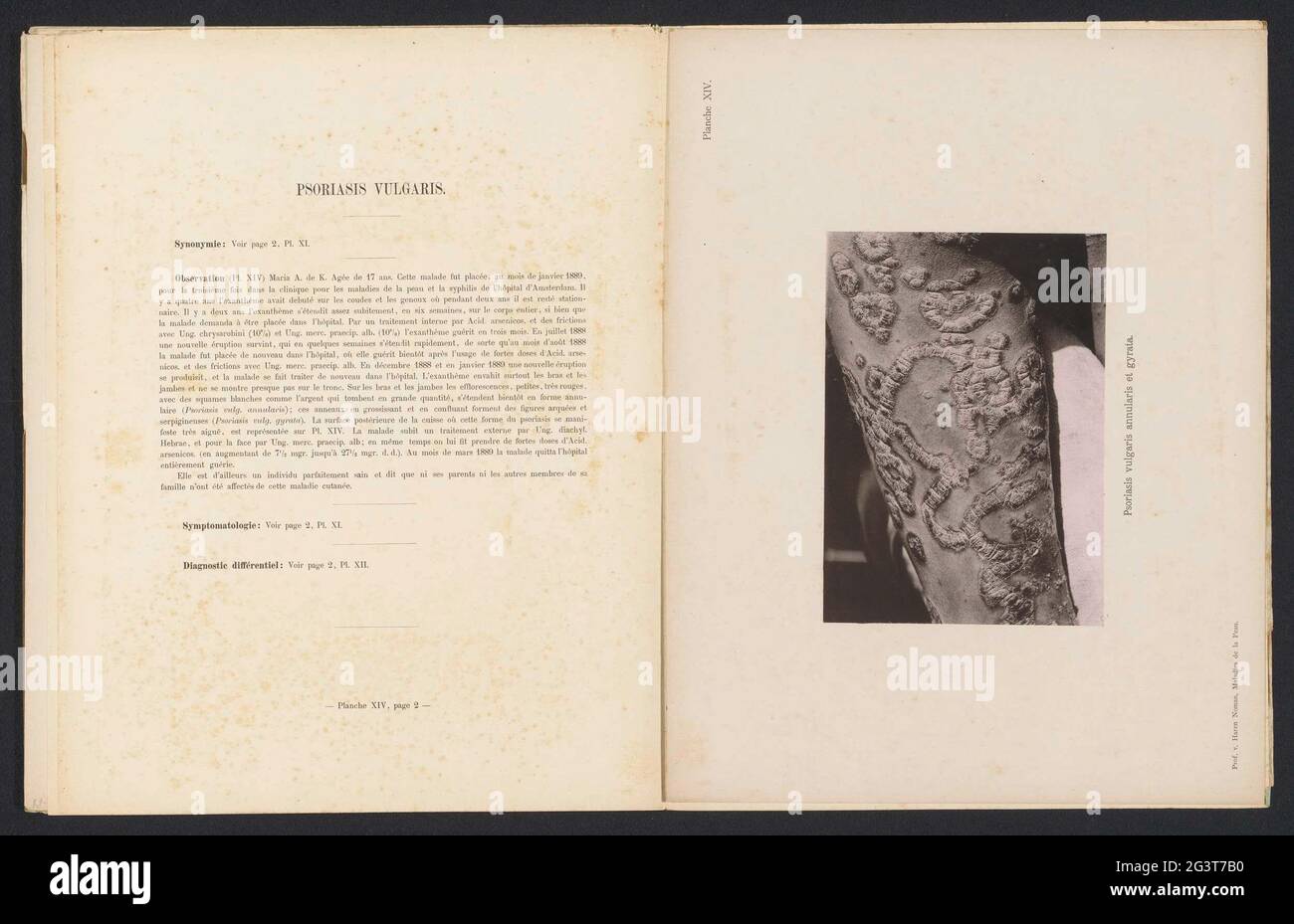 Patient suffering from the skin disease 'Psoriasis vulgaris annulaaris ...