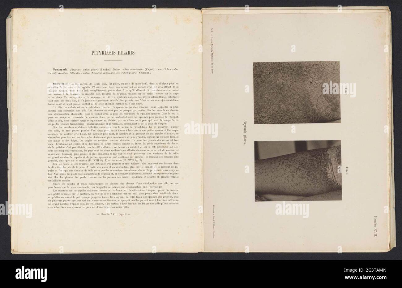 Patients suffering from the skin disease 'Pityriasis Pilaris'; Piist ...