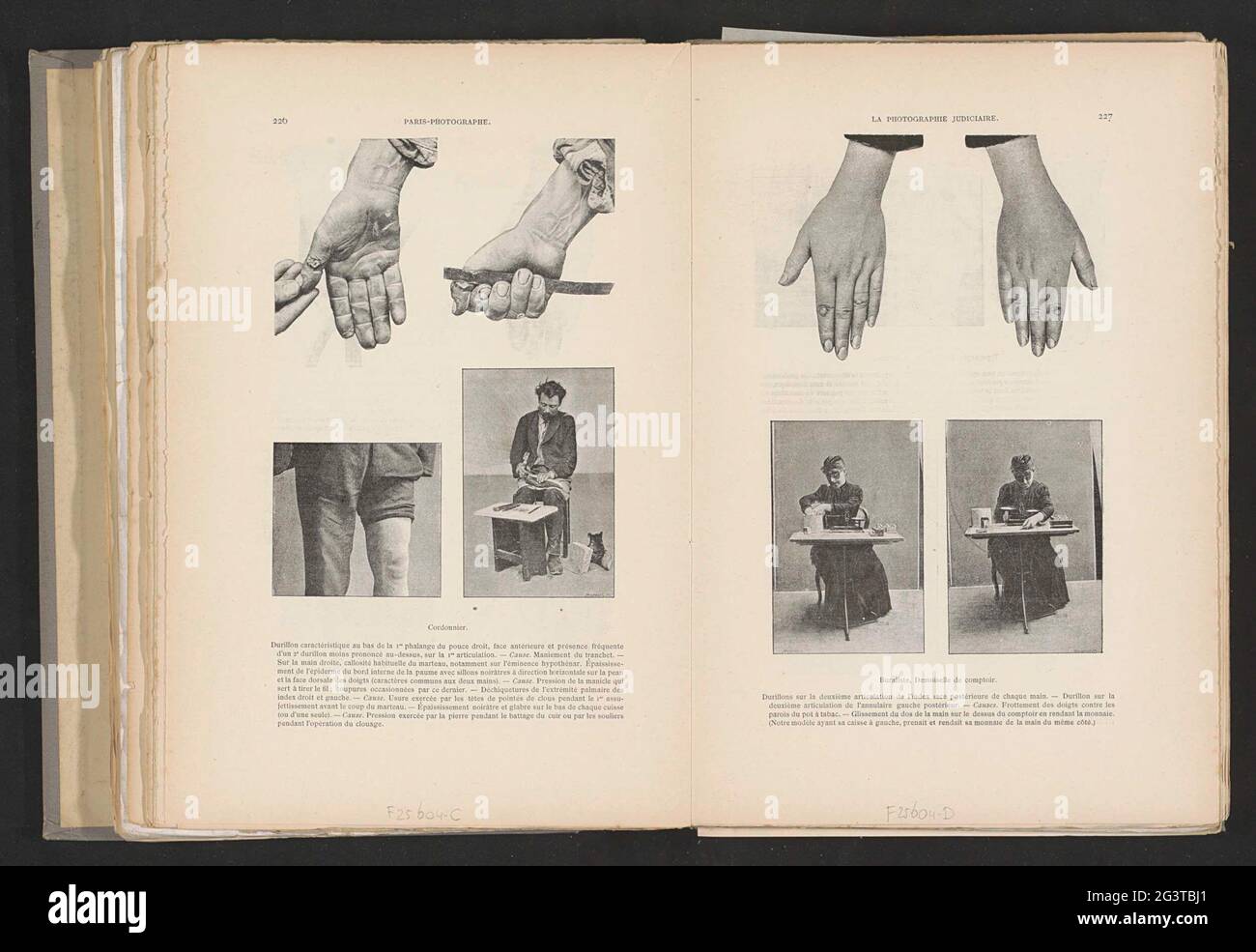 Four images of calluses to the hands and legs of a shoemaker ...