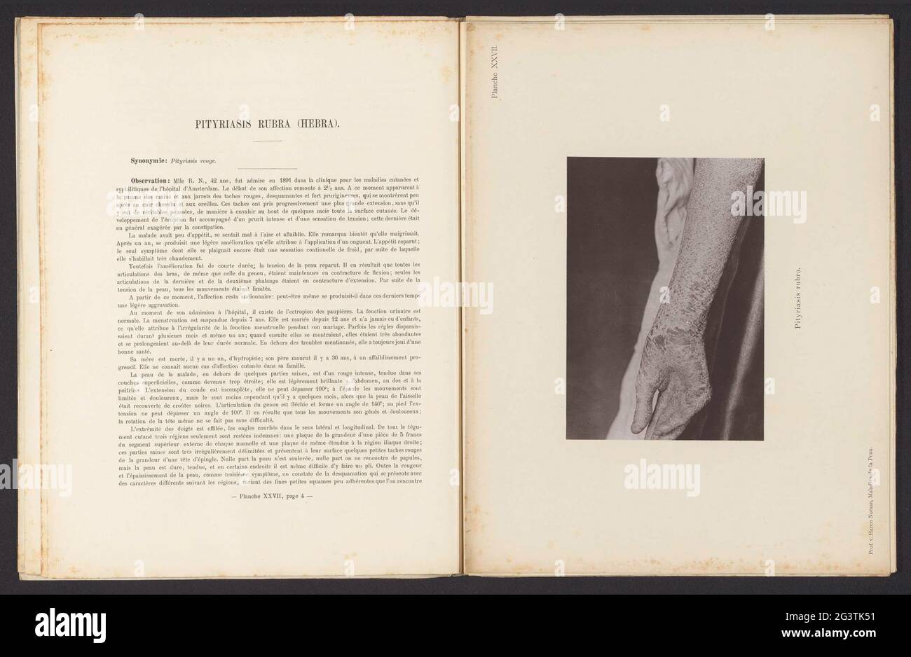 Patient suffering from the skin disease 'Pityriasis Rubra'; Pityriasis ...