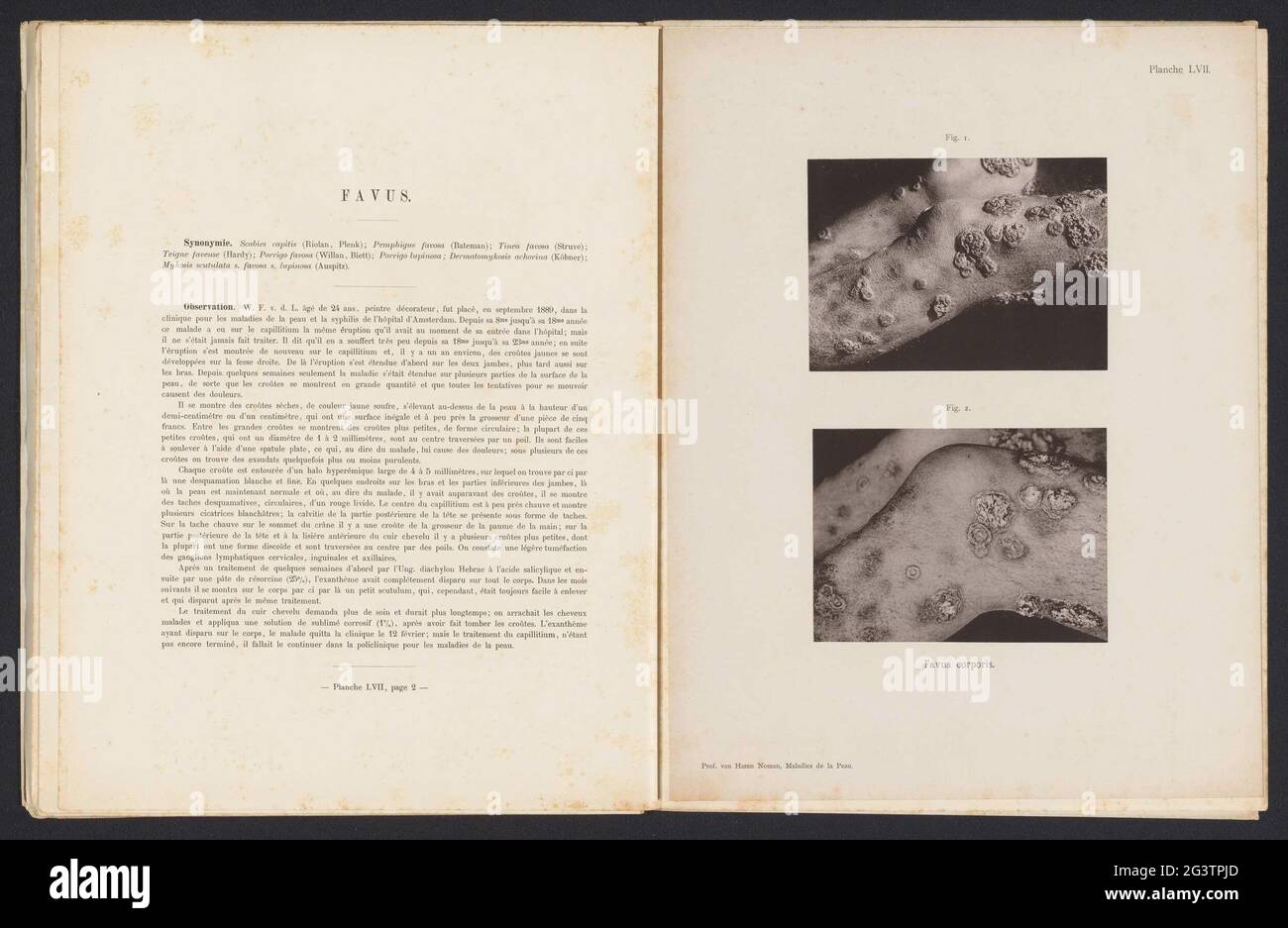 Patients suffering from the skin disease 'Favus Corporis'; Gangraena ...