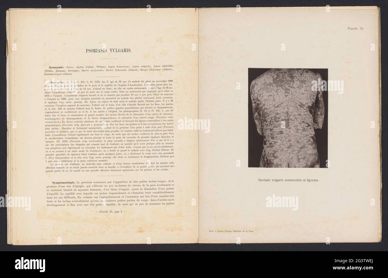 Patient suffering from the skin disease 'psoriasis vulgaris nummularis ...