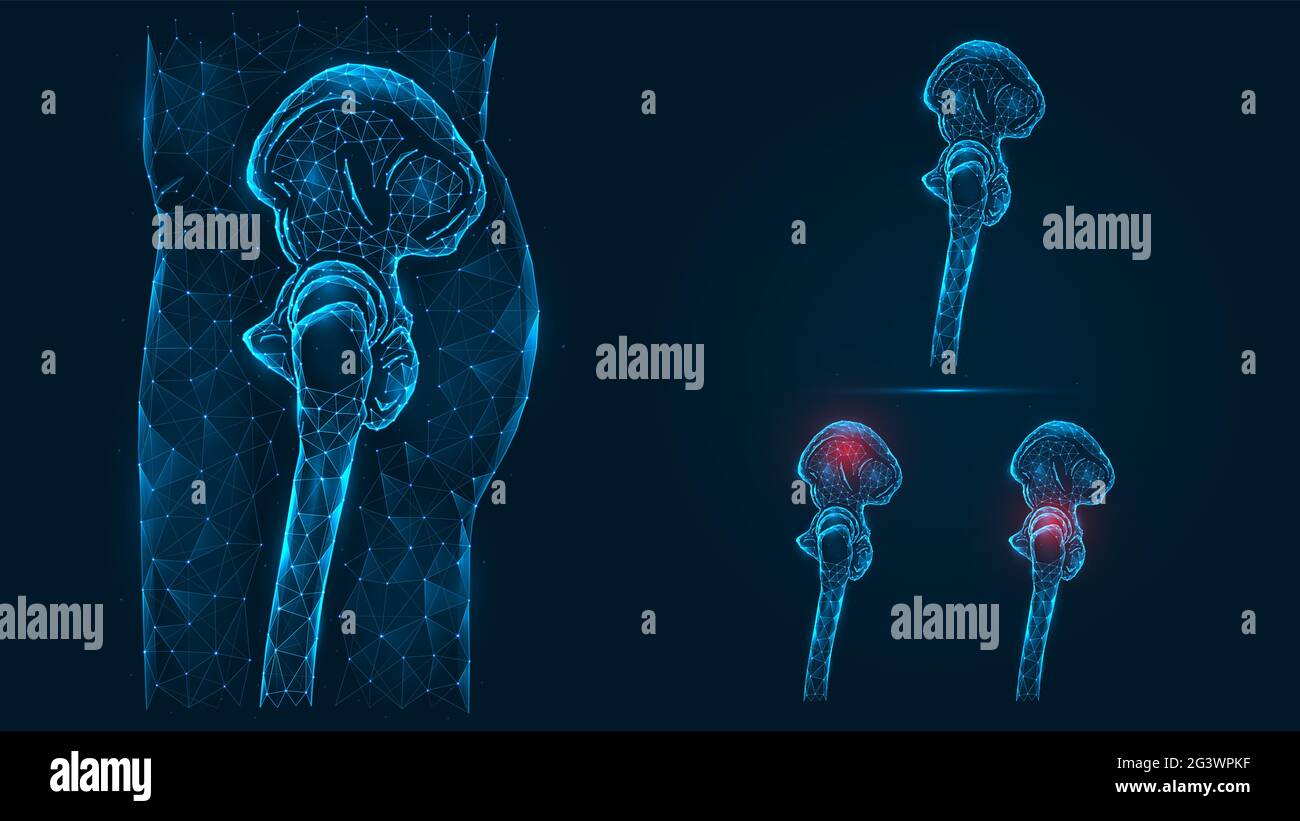 Polygonal illustration of human pelvic and hip bones side view. Disease ...