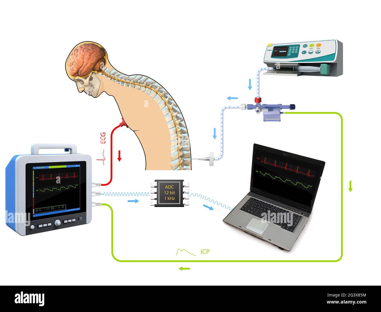 Lumbar puncture needle hi-res stock photography and images - Alamy
