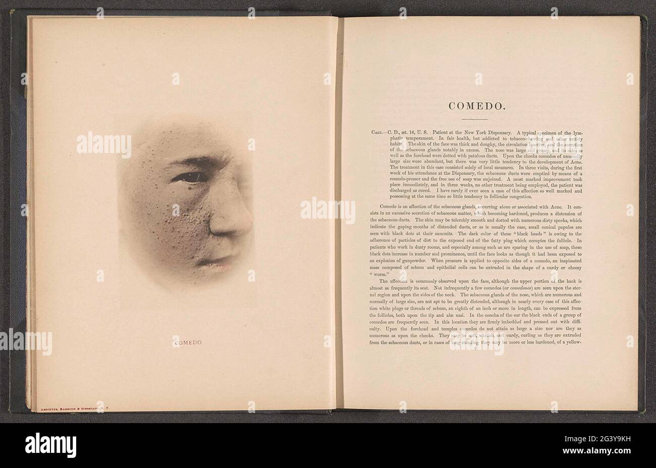 Patient suffering from the "comedo" skin disease; Comedo Stock Photo ...