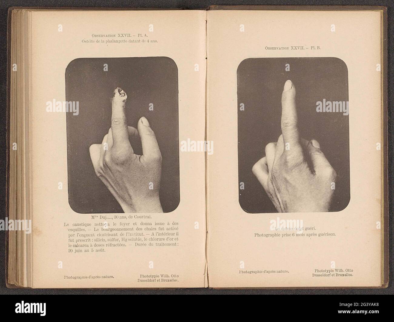 Finger with an infected wound (osteomyelitis Stock Photo - Alamy