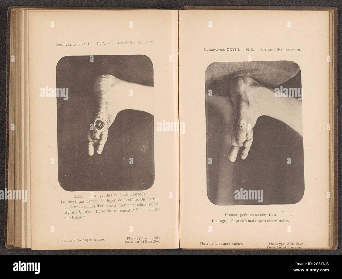 Gangrene foot hi-res stock photography and images - Alamy