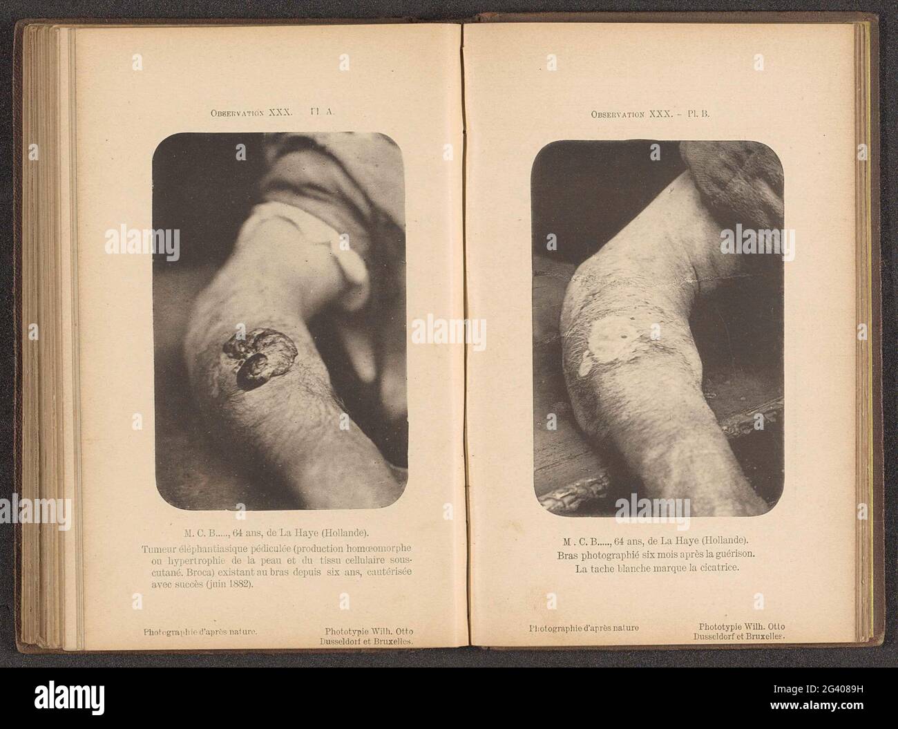 Arm with a scar after removing a tumor Stock Photo - Alamy