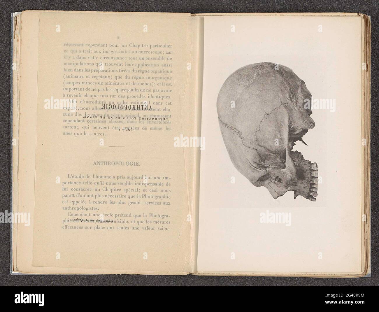 Human skull with a distortion; Déformation Toulousaine du Crâne Stock ...