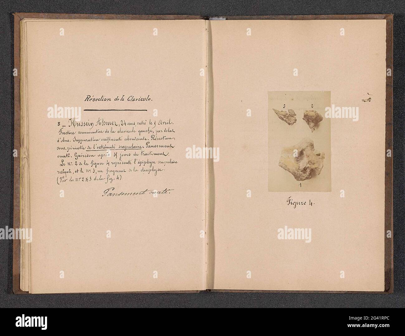 Three parts of a shoulder blade after surgery Stock Photo - Alamy