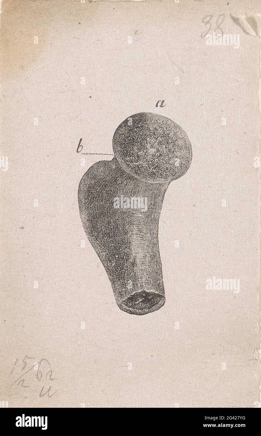 Human bone with a deviation Stock Photo - Alamy