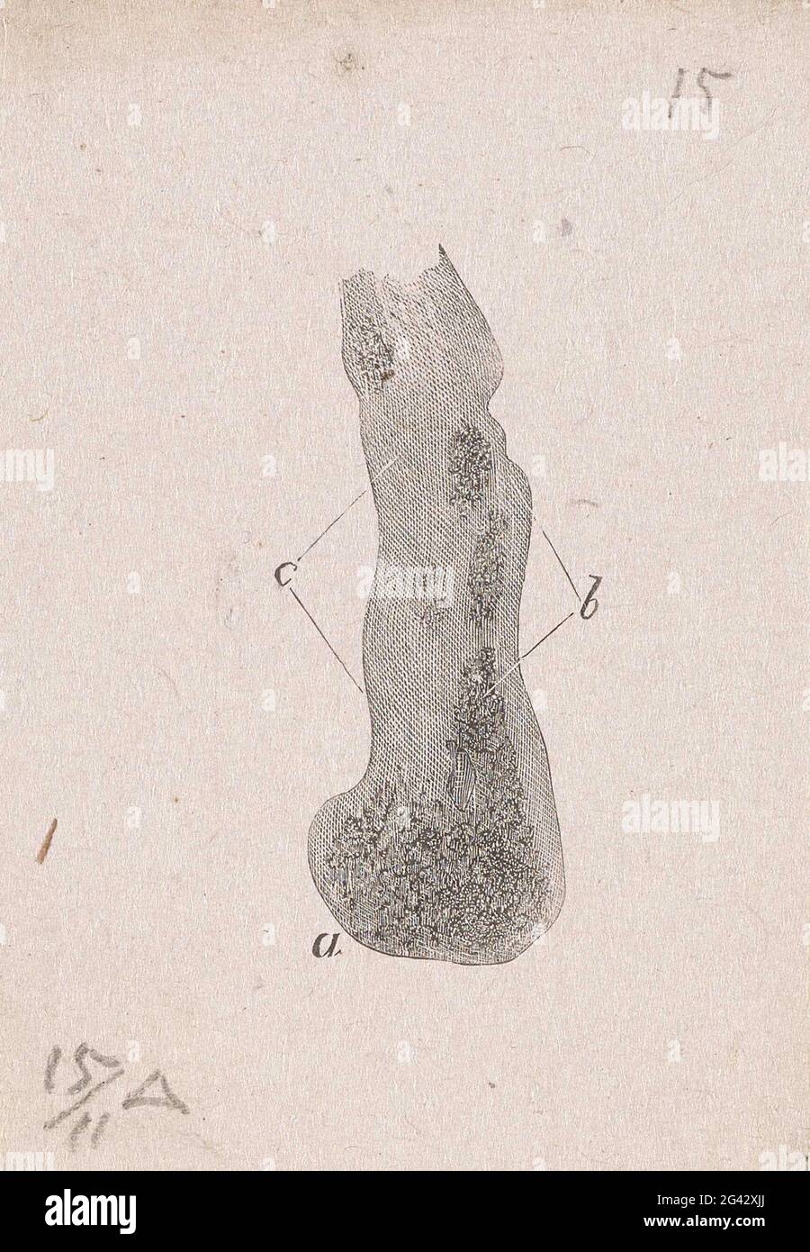 Human bone with a deviation Stock Photo - Alamy