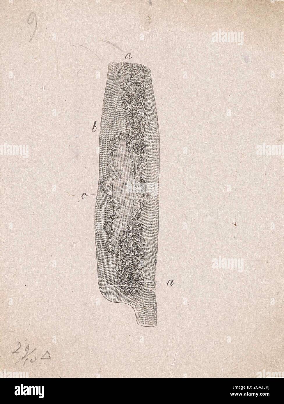 Human bone with a deviation Stock Photo - Alamy
