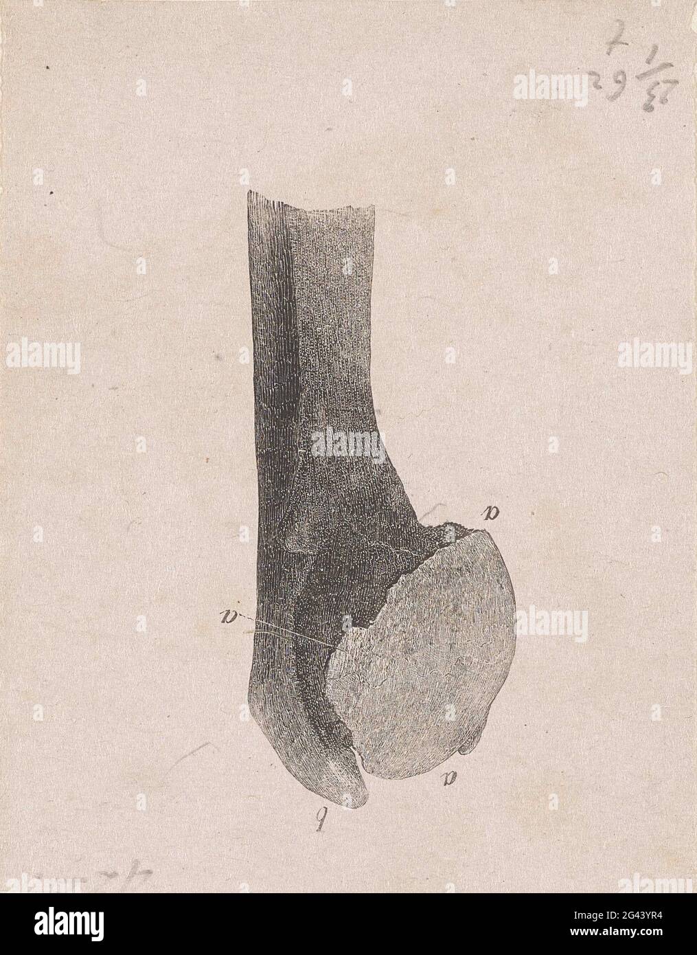 Human bone with a deviation Stock Photo - Alamy