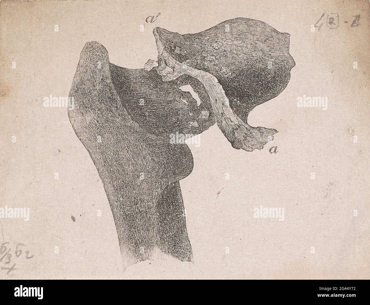 Human bone with a deviation Stock Photo - Alamy