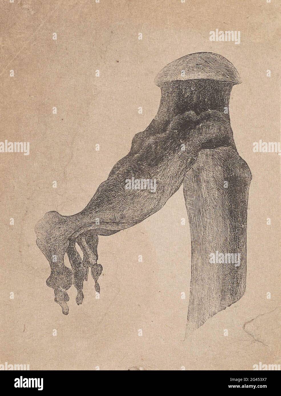 Human bone with a deviation Stock Photo - Alamy