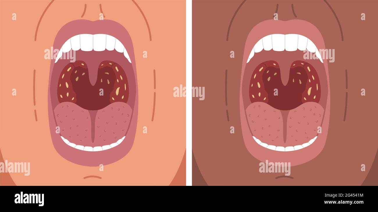 Scornach Strep Vs Tonsillitis