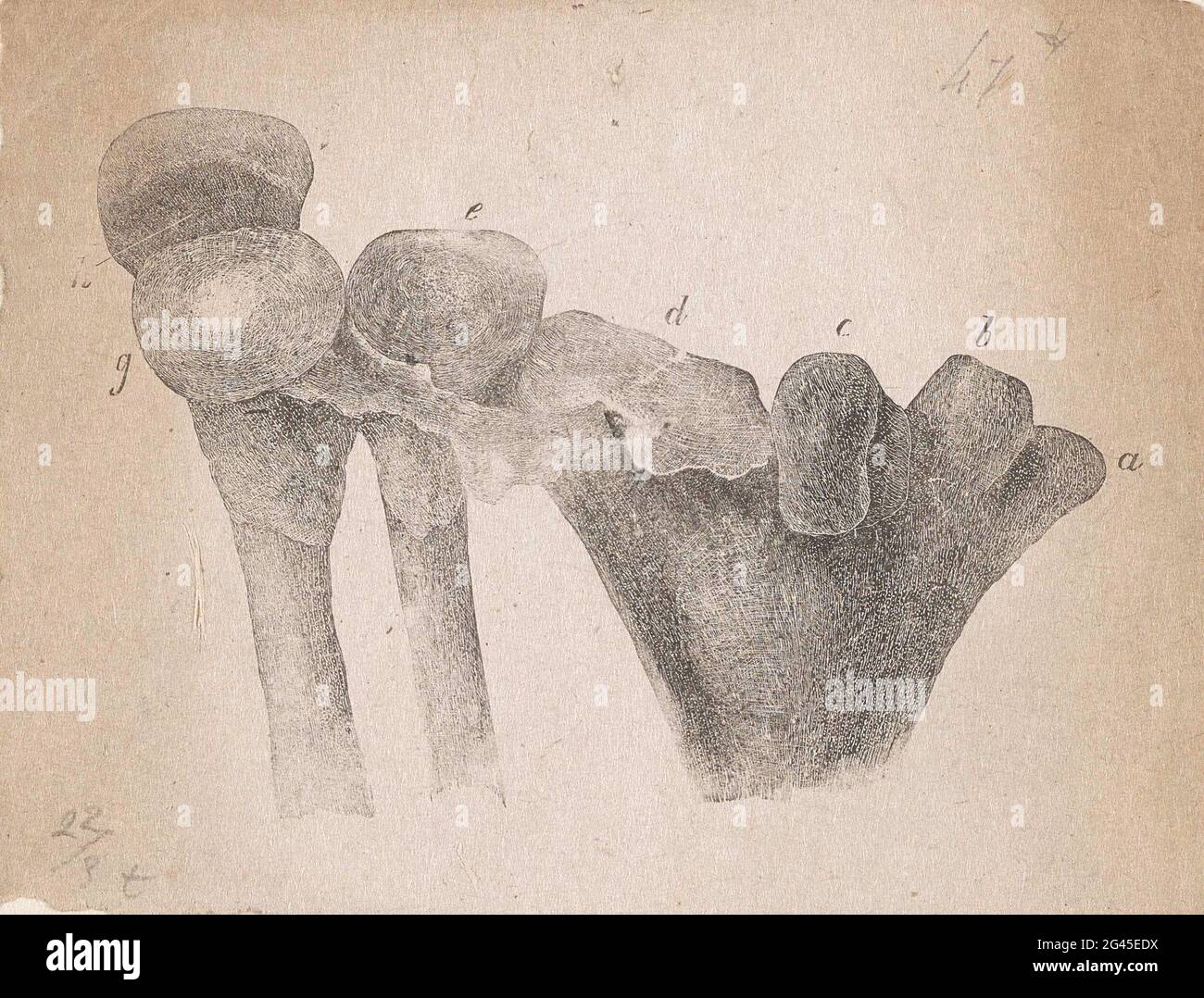 Human bone with a deviation Stock Photo - Alamy