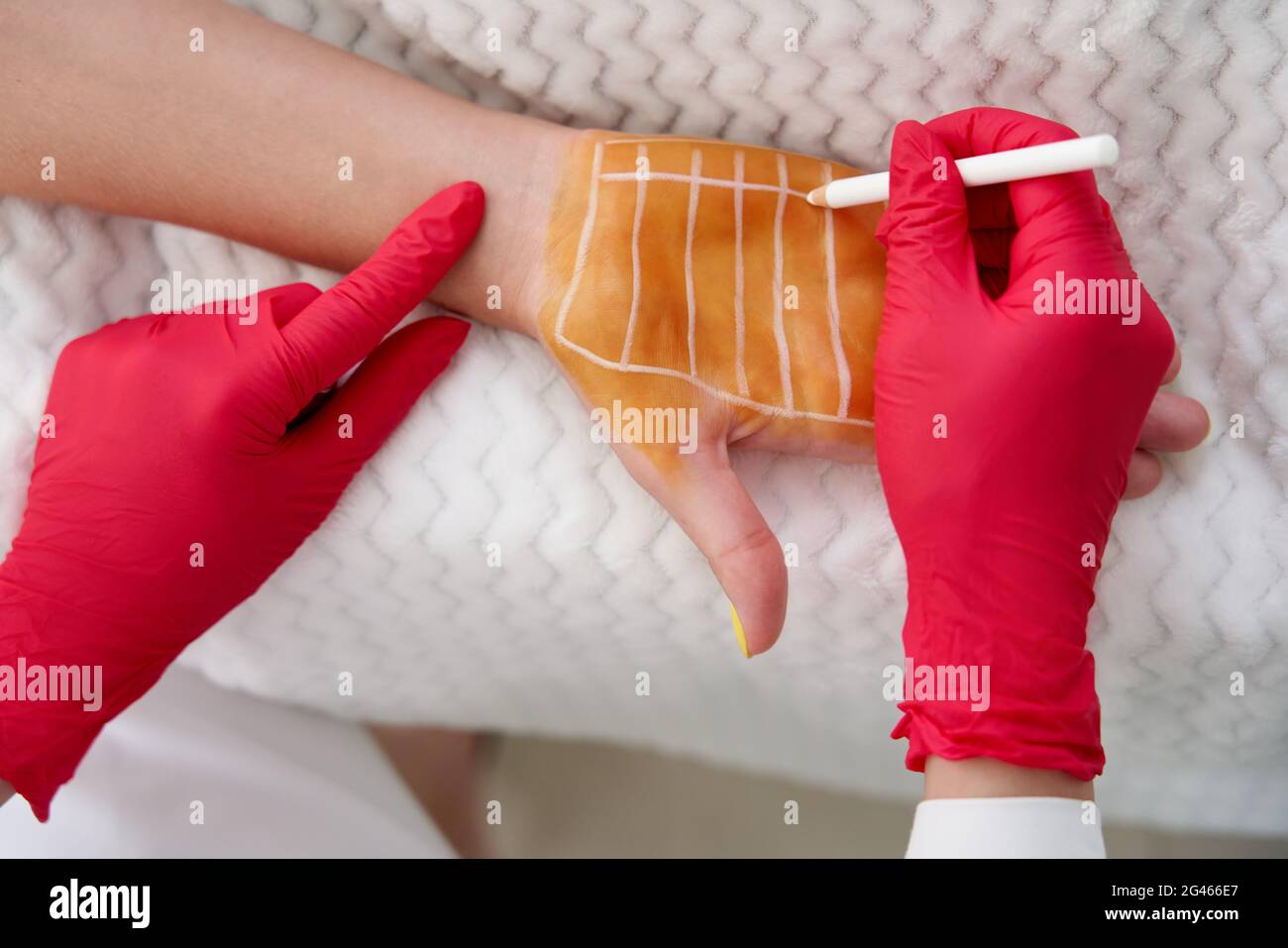cosmetologist makes injections of botulinum toxin on the palms of a ...