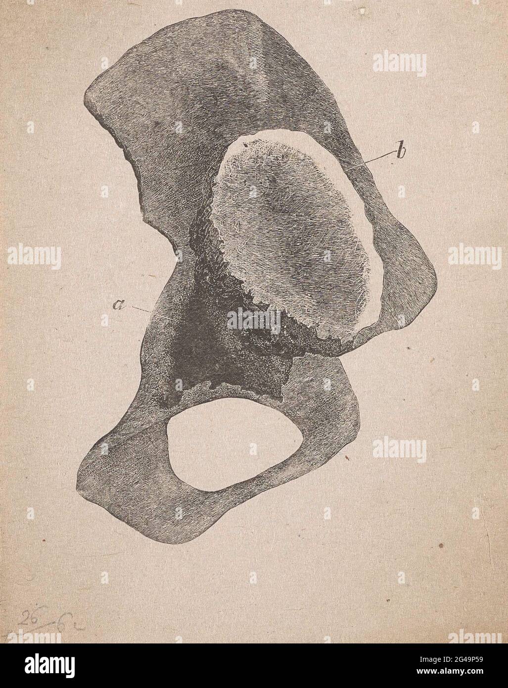 Human bone with a deviation Stock Photo - Alamy