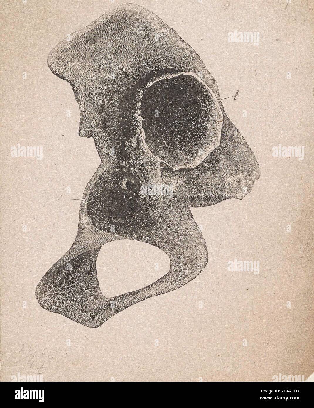 Human bone with a deviation Stock Photo - Alamy