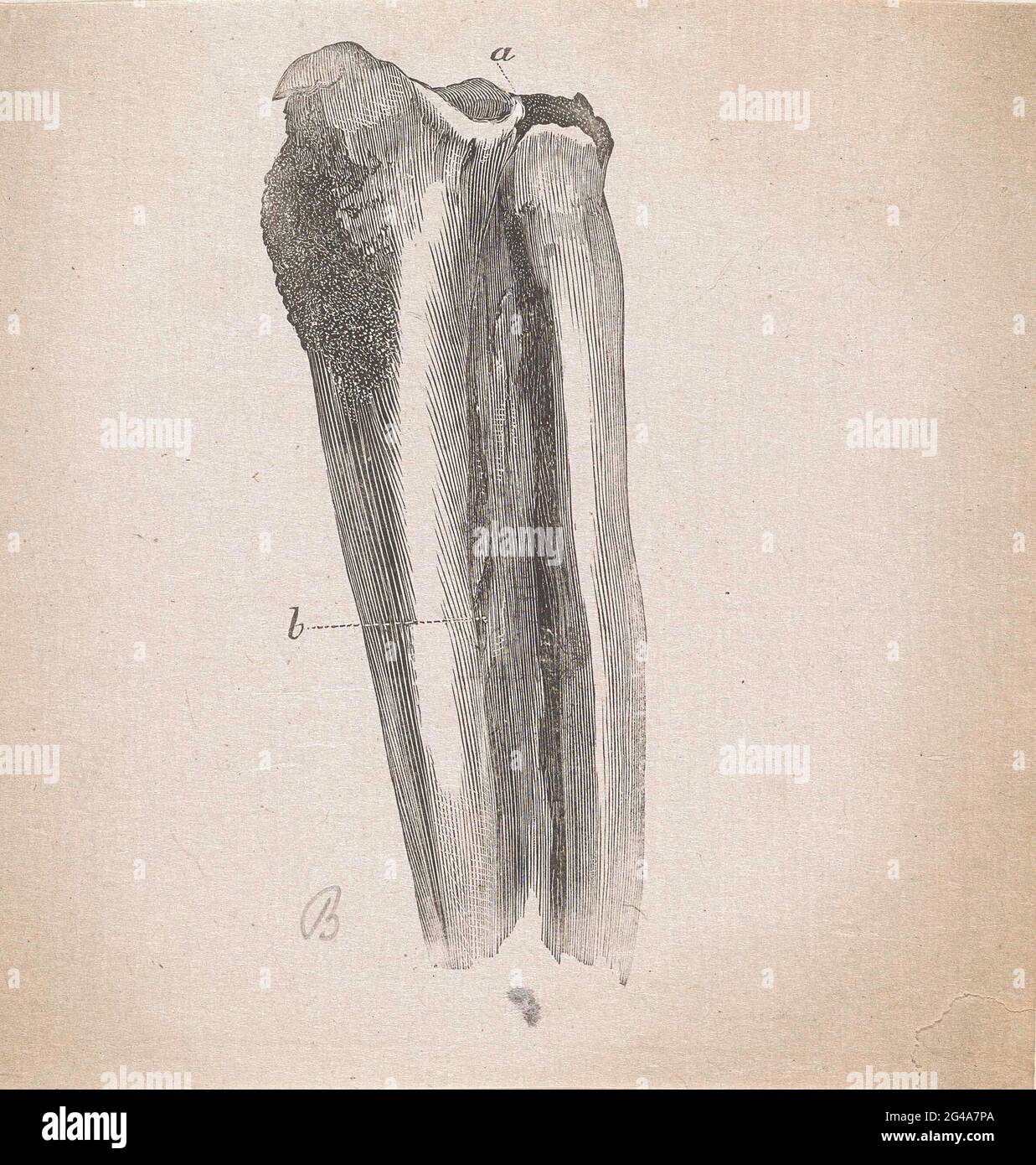 Human bone with a deviation Stock Photo - Alamy