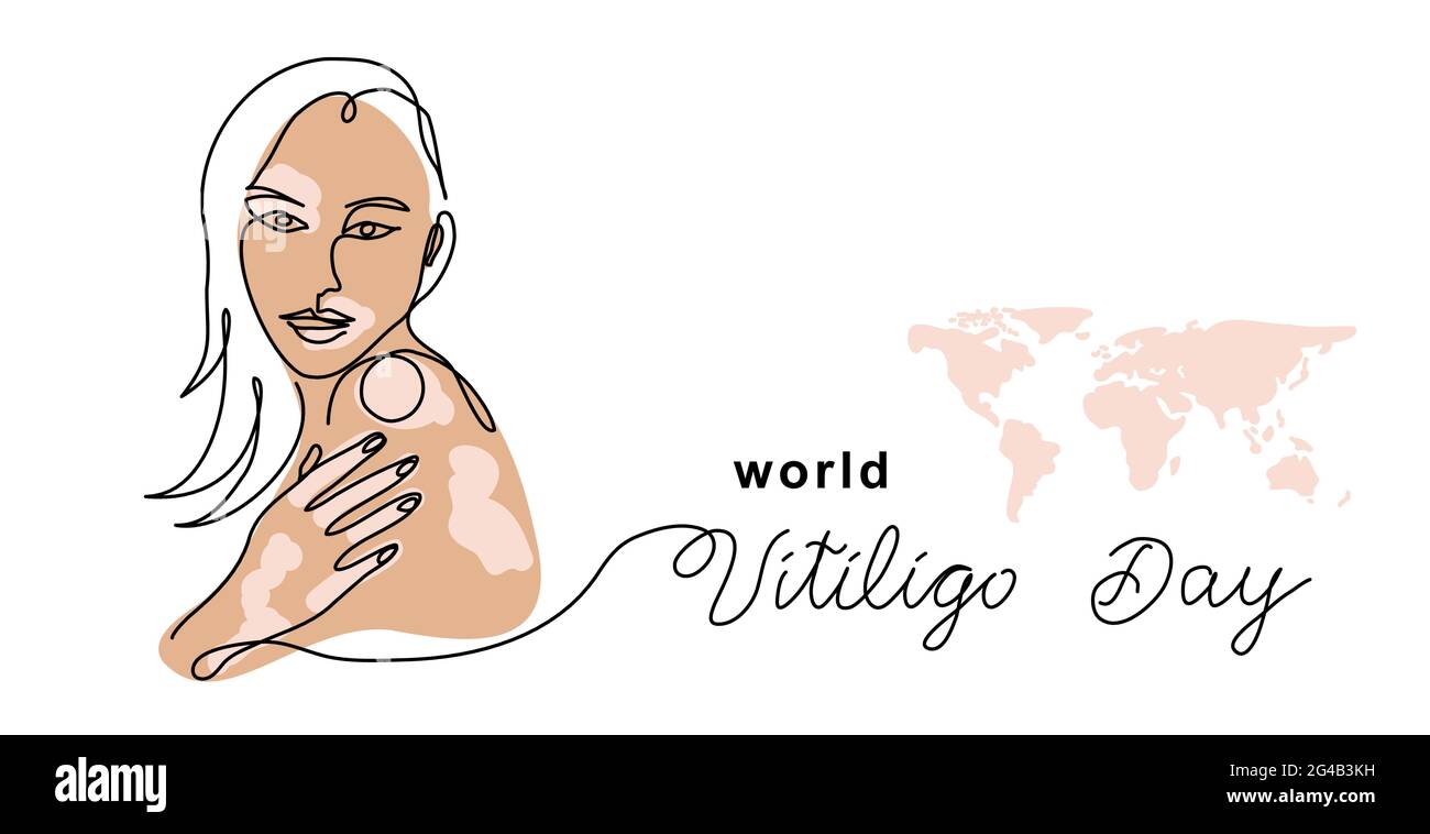 World vitiligo day vector banner, poster, background. Woman with ...