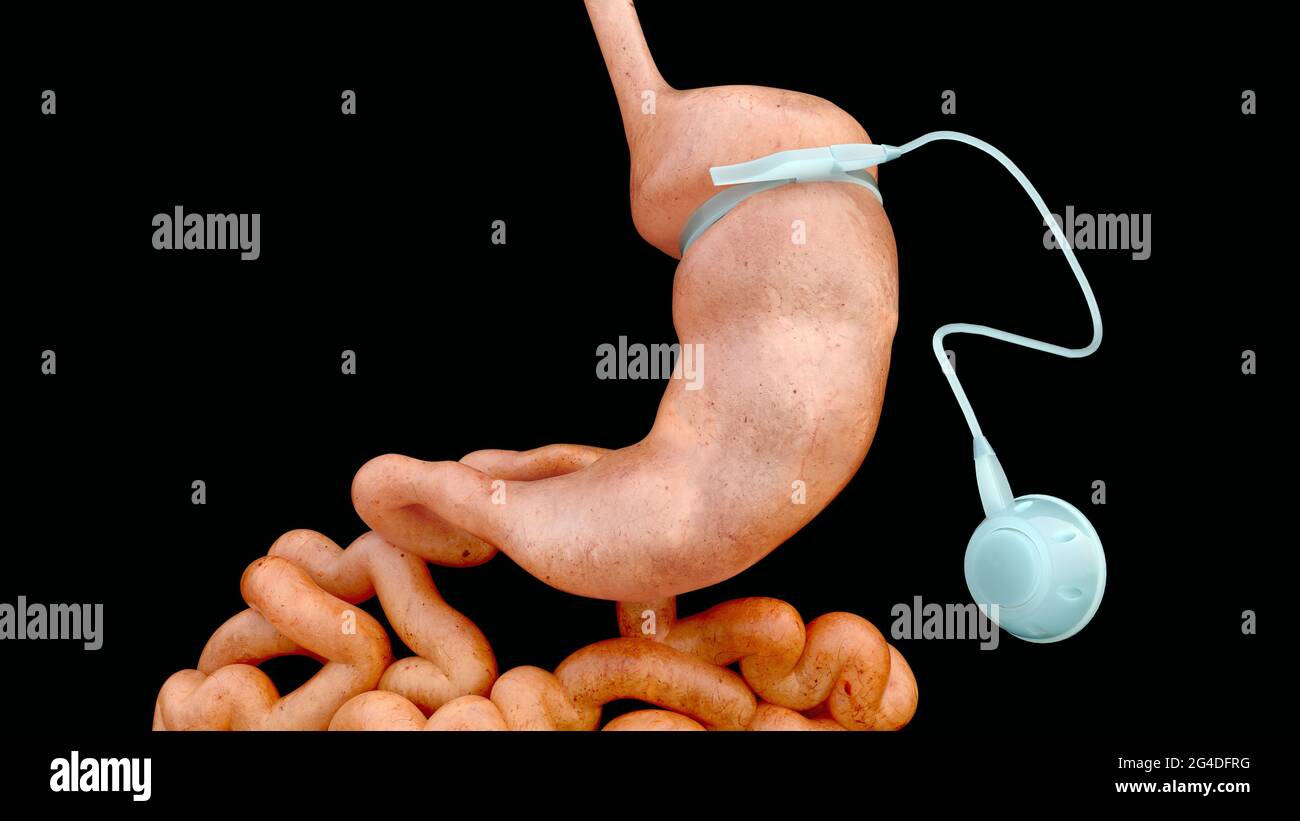 Stomach reduction surgery technique as 3D rendering Stock Photo - Alamy