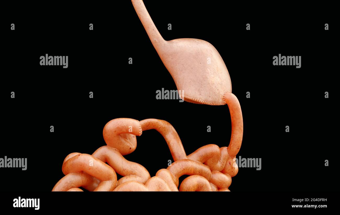 Stomach reduction surgery technique as 3D rendering Stock Photo - Alamy