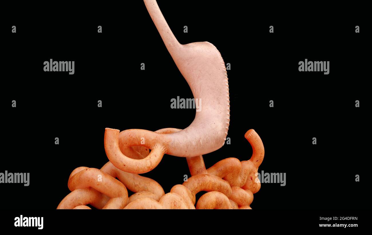 Stomach reduction surgery technique as 3D rendering Stock Photo - Alamy