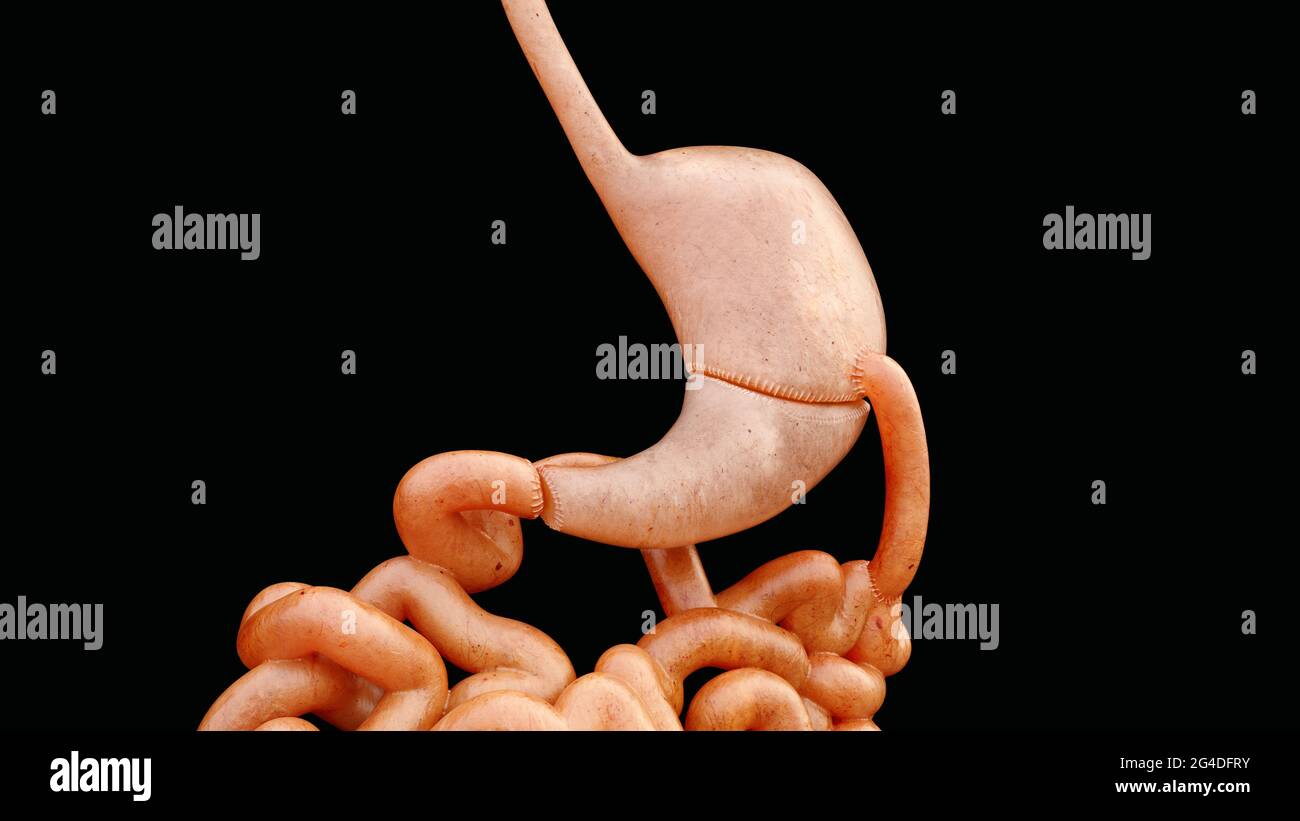 Stomach reduction surgery technique as 3D rendering Stock Photo - Alamy