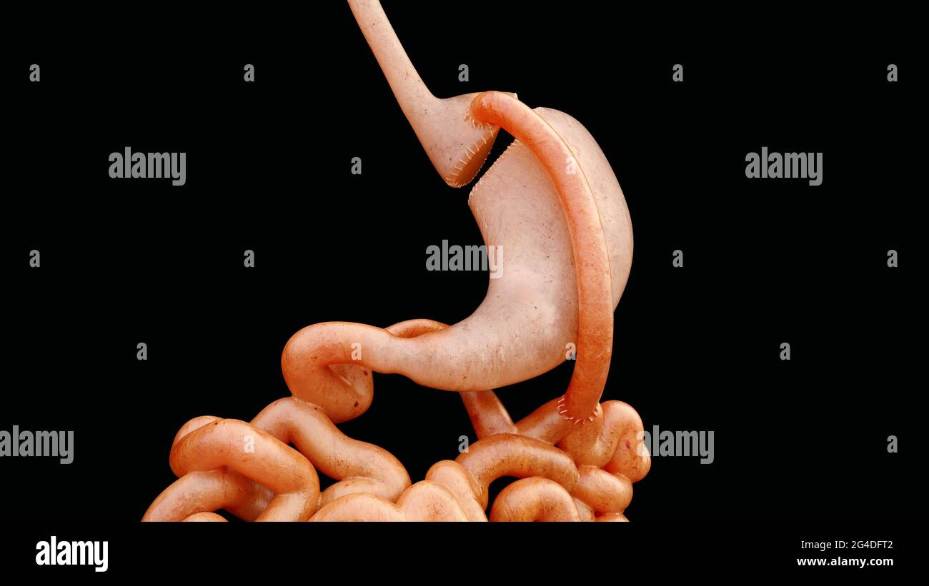 Stomach reduction surgery technique as 3D rendering Stock Photo - Alamy