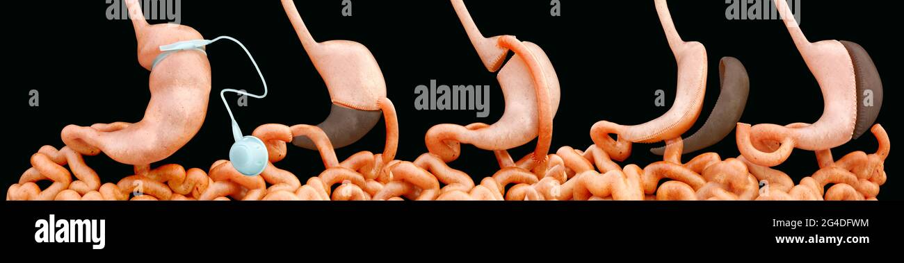 Stomach reduction 5 surgical techniques at a glance Stock Photo - Alamy