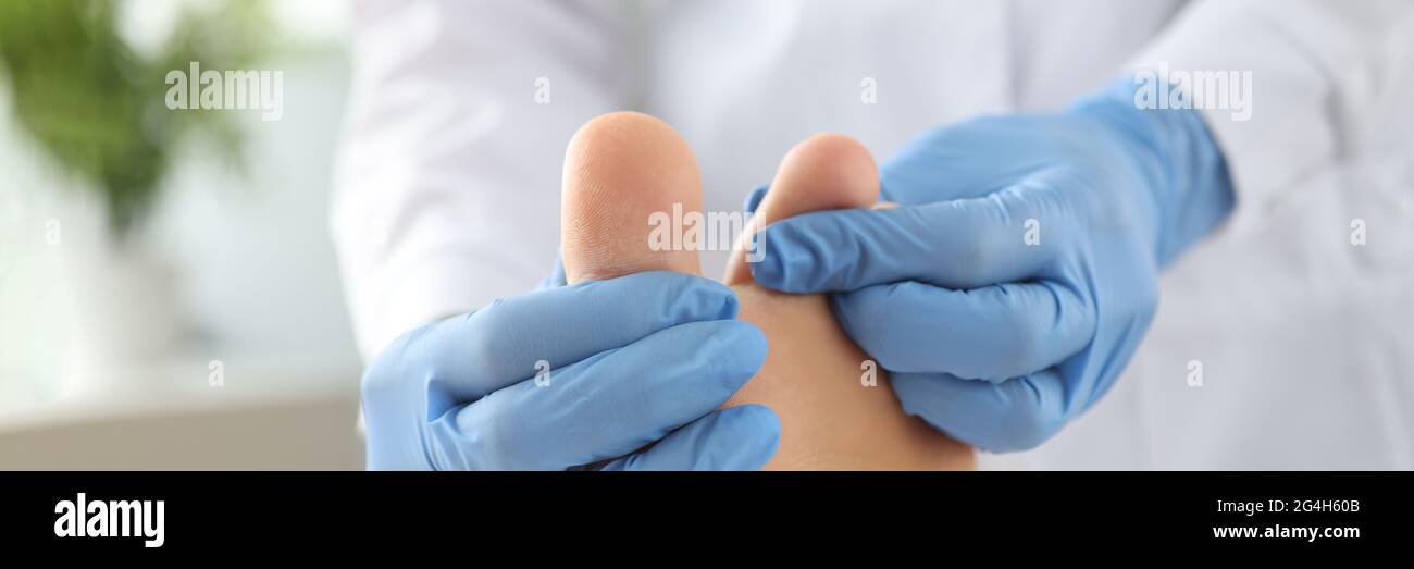 Gloved doctor examines patient's skin on leg between toes Stock Photo ...