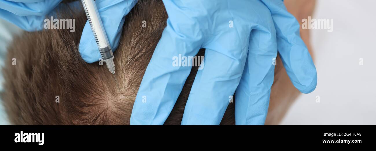 Doctor trichologist makes an injection into the scalp of man Stock ...