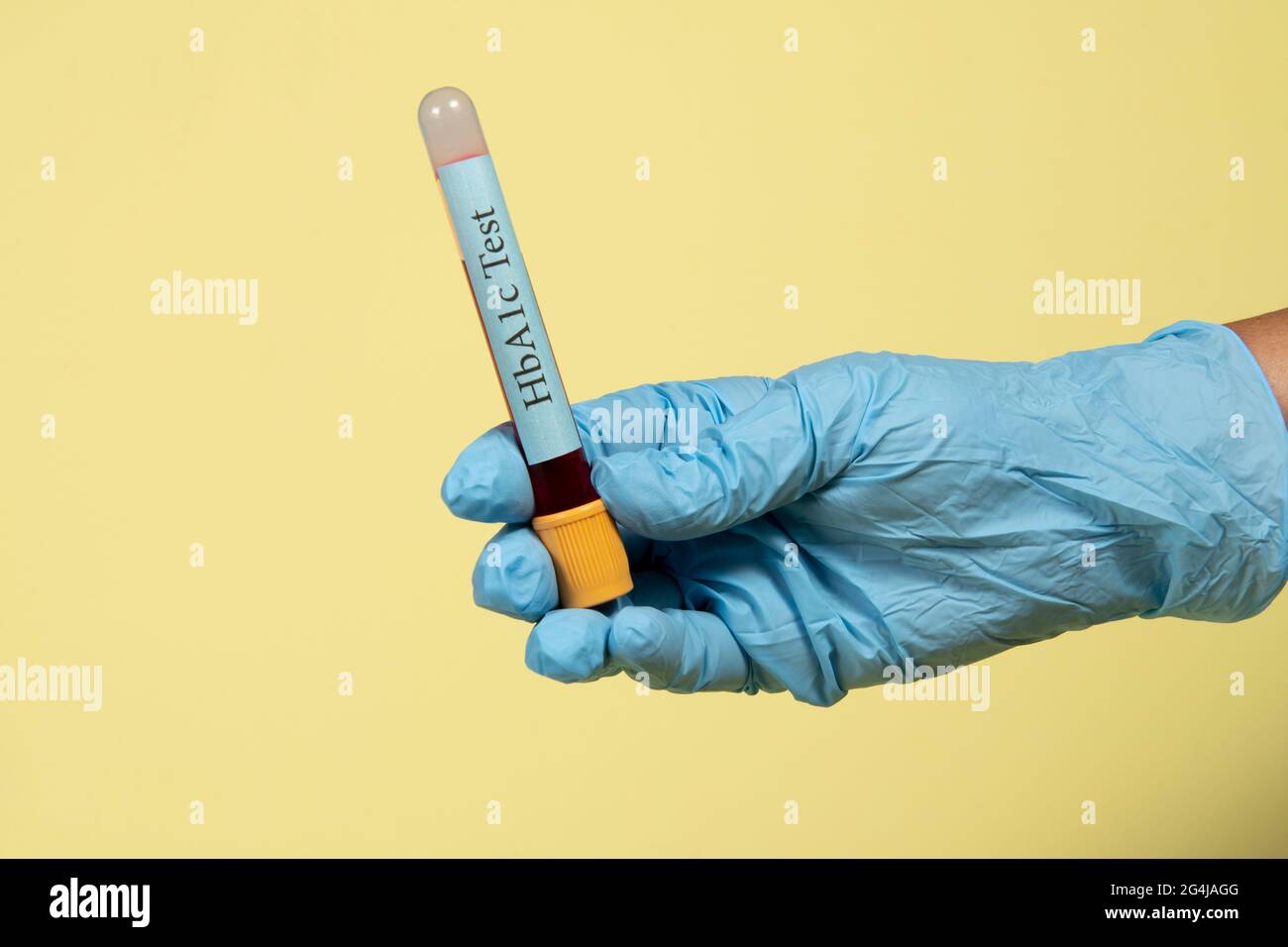 Blood sample in a vacuum tube for hemoglobin HbA1c test diabetes ...