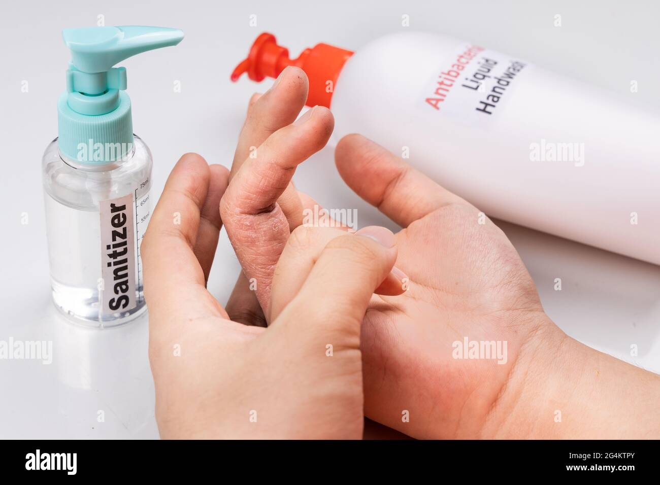 Dry skin on finger with bottle of antibacterial liquid handwash and ...