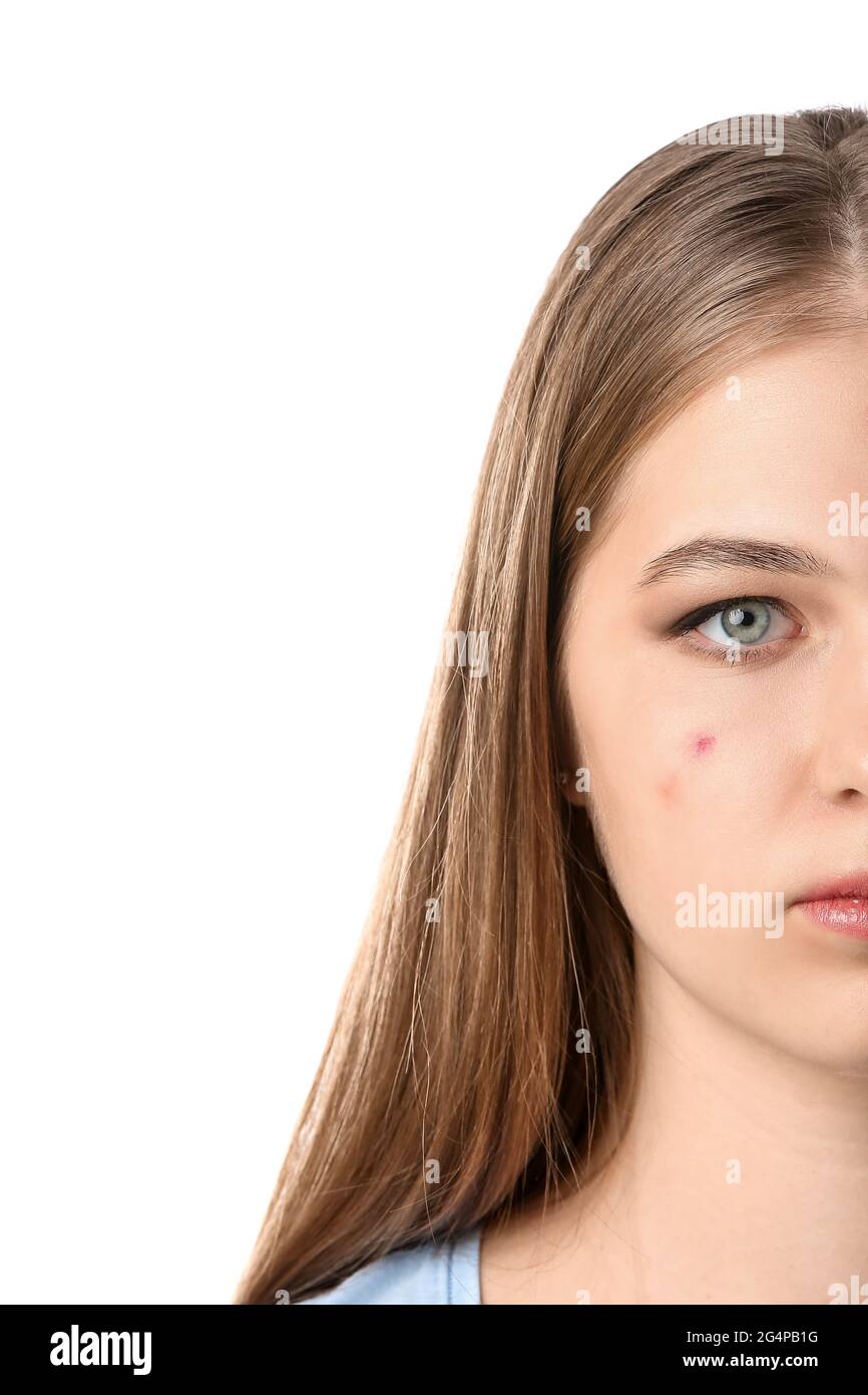 Teenage girl with acne problem on white background Stock Photo - Alamy